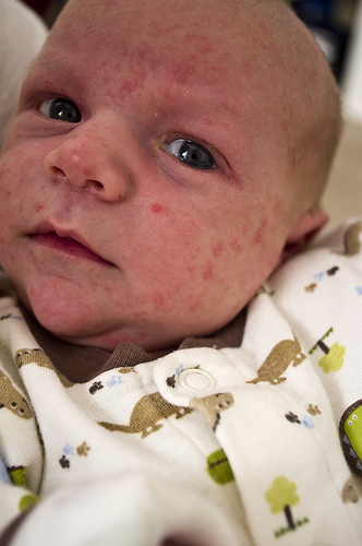 My Newborn Has a Rash. Should I Worry? | My Two Hats